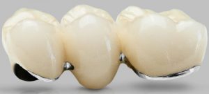 Cena Most Protetyczny (mostek na zęby)