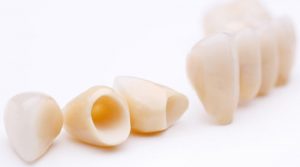 Tandbrug (Vaste Tandprothese)